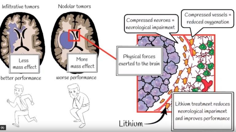 Brain Tumors and Solid Stress